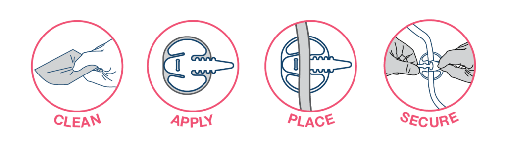 CINCH® Tube Securement Device & Supplies - AMT