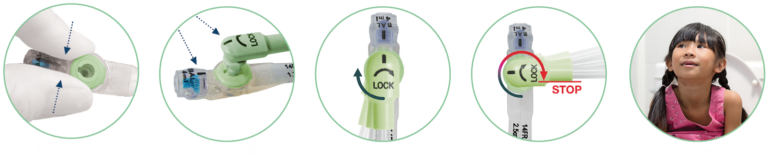 MiniACE® Enema Button, Antegrade Continence Enema Button - AMT