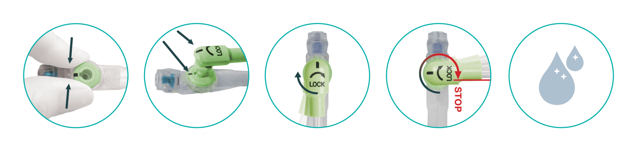 MiniSPC™ Button Suprapubic Catheter, Low Profile - AMT